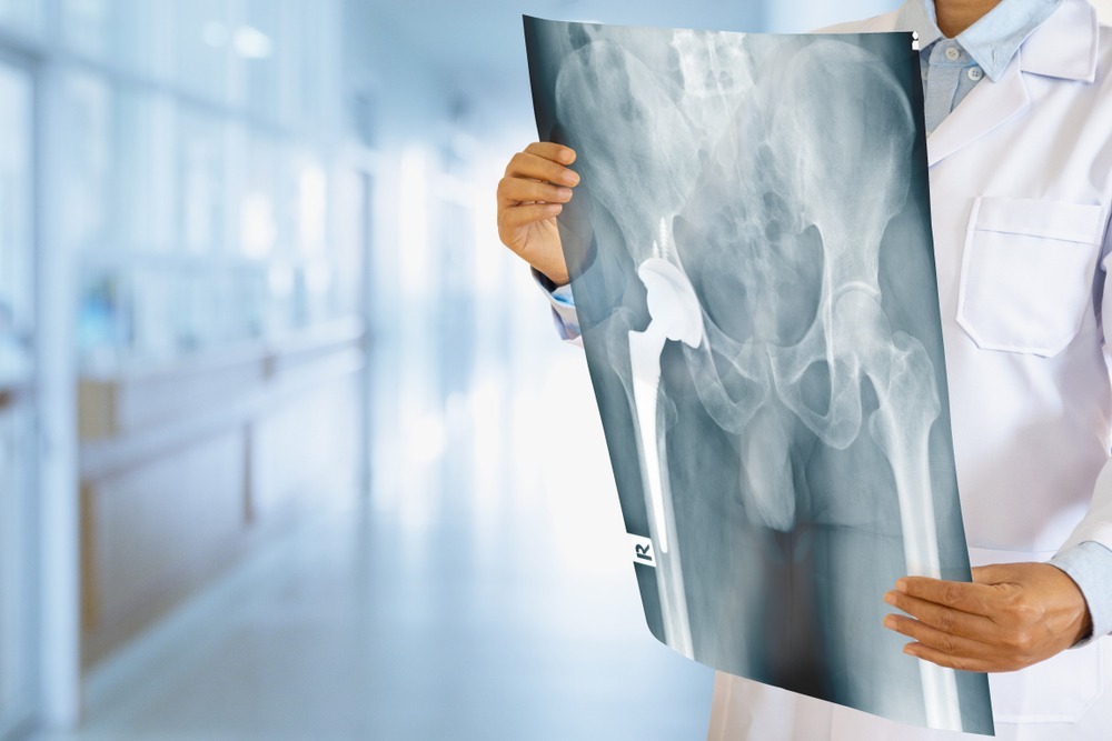 Biomet Hip Replacement Lawyer in Atlanta | Free Consultation